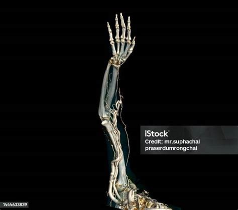 Arteri Brakialis Lengan Dengan Rendering 3d Tulang Ekstremitas Atas