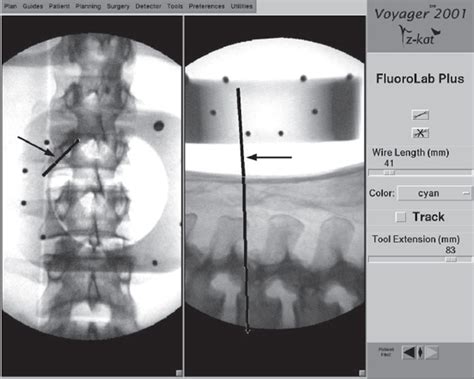 Computer Assisted Spinal Surgery Musculoskeletal Key