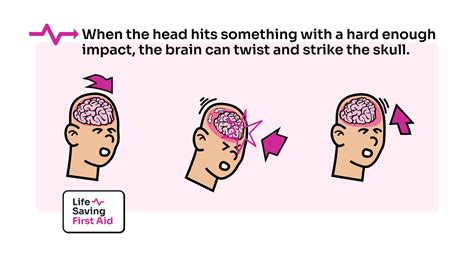 Head Injuries Life Saving First Aid