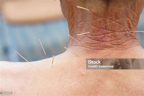 Foto De Médico Enfia Agulhas No Corpo Humano Na Acupuntura Medicina