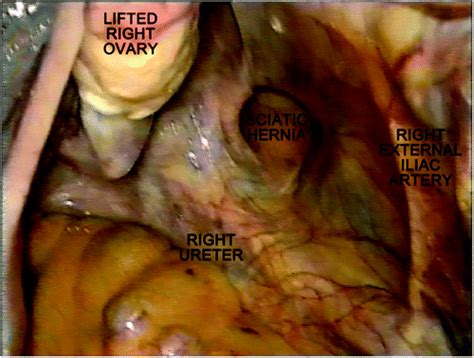 Sciatic Foramen Hernia
