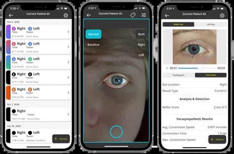 Pupillary Light Reflex Testing Reinvented Reflex App • Hcc