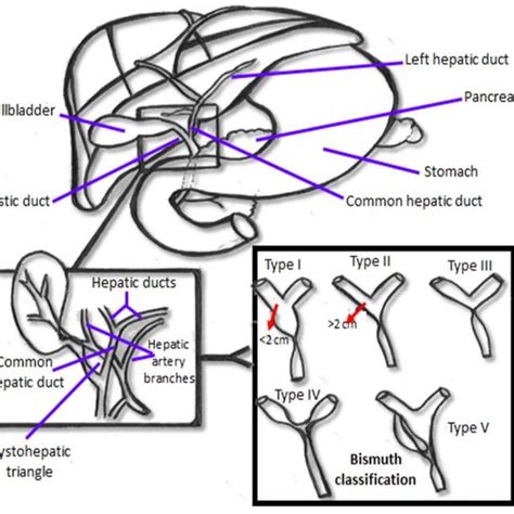 Liver Biliary Tract Anatomy And Bismuth Classification Download