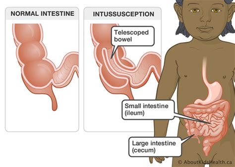 Ch 30 Intussusception Flashcards Quizlet