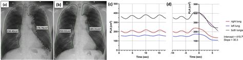 Dxr Reveals Lung Hyperinflation In Patients With Copd