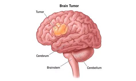 World Brain Tumor Day Types Affects Symptoms And Treatment