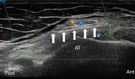 A Denervation Of The Infrapatellar Branch Of The Saphenous Nerve