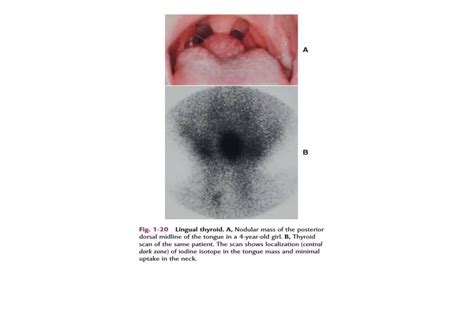 Lingual Thyroid Nodule Pptx