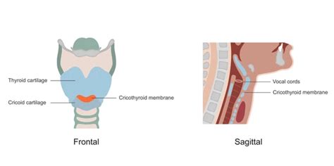 Cricothyroid Membrane Incision