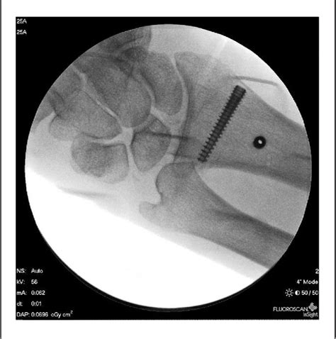 Figure 1 From Role Of Laser Pointer In Budgeting Fluoroscopy Time And