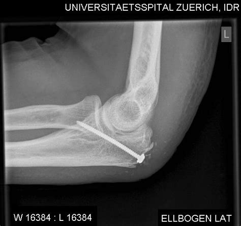 Triceps Tendon Avulsion Physiopedia
