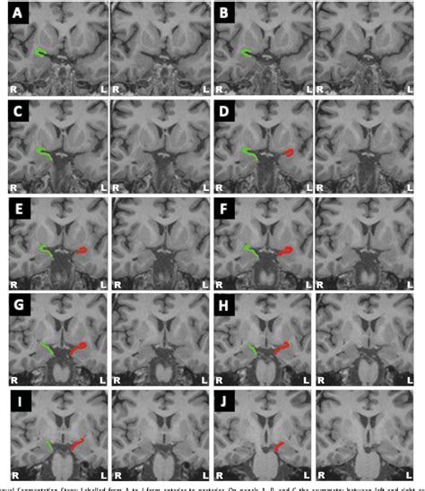 Figure 1 From Resection Of The Piriform Cortex For Temporal Lobe