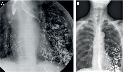Barium Aspiration The American Journal Of The Medical Sciences
