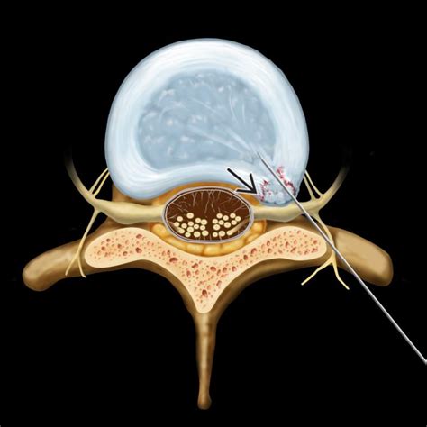 Percutaneous Discectomy Clinical Tree