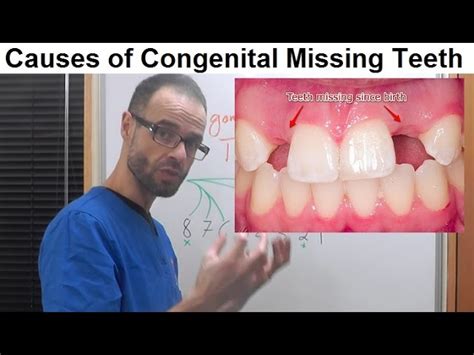 Congenitally Missing Teeth