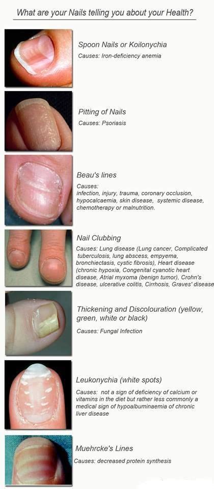 Abnormal Fingernails