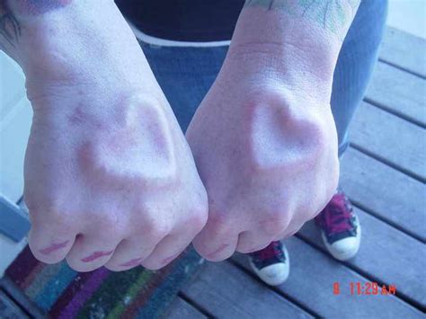 Implants Body Piercing And Modification