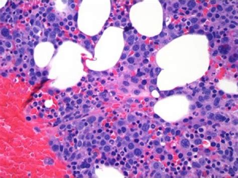 Bone Marrow Biopsy Shows A Mildly Hypercellular Marrow Averaging 50 To