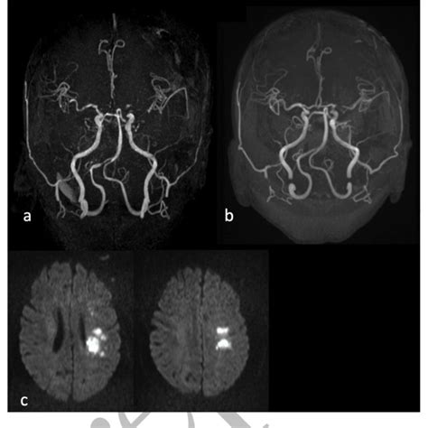 A Mra From Post Operative Day 11 Diffuse Vasospasm At The Bilateral