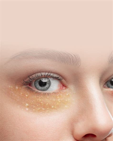 Milia Under Eye Treatment Causes And Prevention In India Mfine