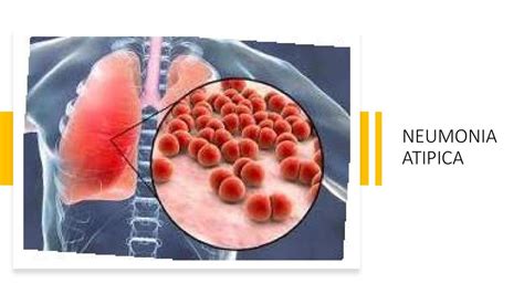 Histología De Neumonía Atípica