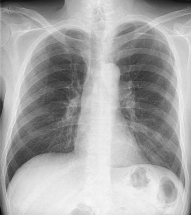 Apical Pneumothorax Radiology Case Radiopaedia Org