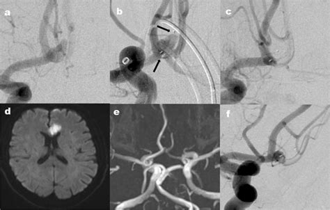 Ruptured Acom Aneurysm Treated With Web Device Dsa Before Embolization