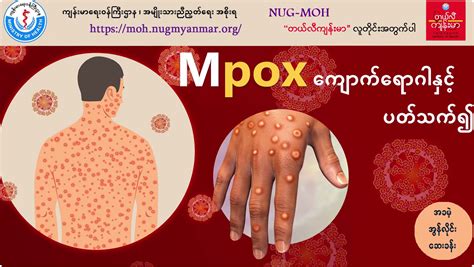 အဖြစ်များနေတဲ့ Mpox ကျောက် ရောဂါနှင့်ပတ်သက်၍ သိထားသင့်သည်များ Mpox Video August 2024