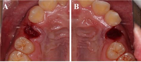 Figure 1 From Demineralized Dentin Matrix Promotes Gingival Healing In