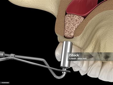 부 비 동 리프트 수술새로운 뼈를 추가 합니다 3d 일러스트레이션 집어들기에 대한 스톡 사진 및 기타 이미지 집어들기