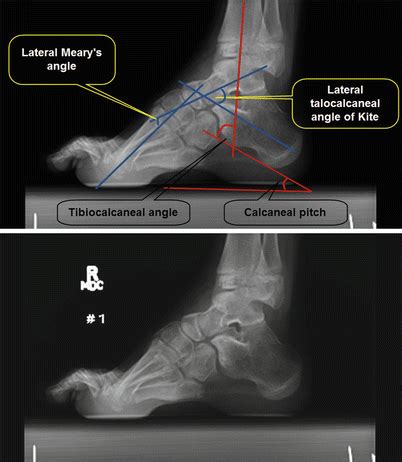 Evidence Based Treatment For Pes Cavus Musculoskeletal Key
