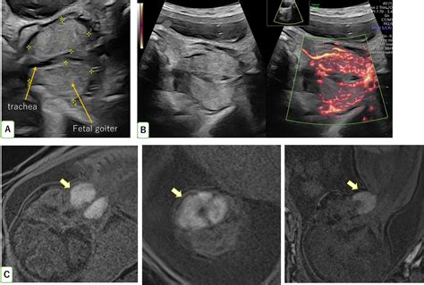 Fetal Goiter Ultrasound