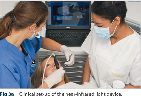 Figure 2 From Caries Detection And Diagnostics With Near Infrared Light Transillumination