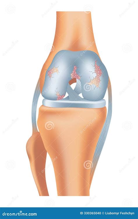 Knee Arthrosis Unhealthy Knee Structure Bone Exposure Damaged Knee