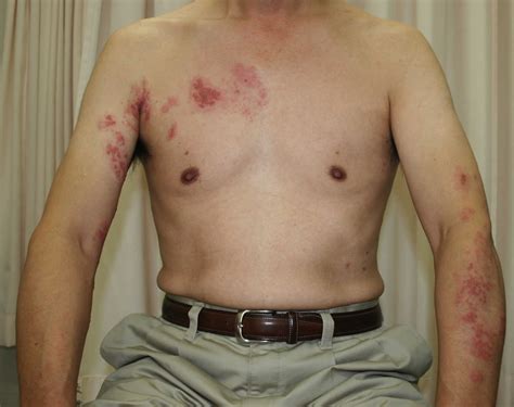 Arm Dermatome Shingles At Stuart Witt Blog