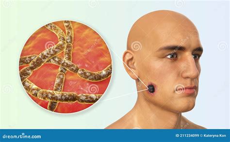 Cutaneous Anthrax The Most Common Form Of Anthrax Stock Illustration