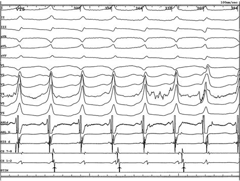 Wide QRS Complex Tachycardia Circulation