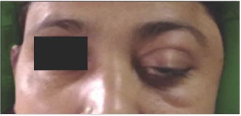 5 Cm × 3 Cm × 4 Cm Swelling Over Left Temporal Region Download