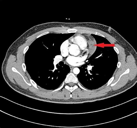 Imaging Chest Enhanced Ct Showed A Mass Of Mixed Density Shadow On The