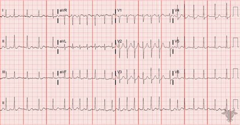 Atrial Fibrillation ECG Stampede
