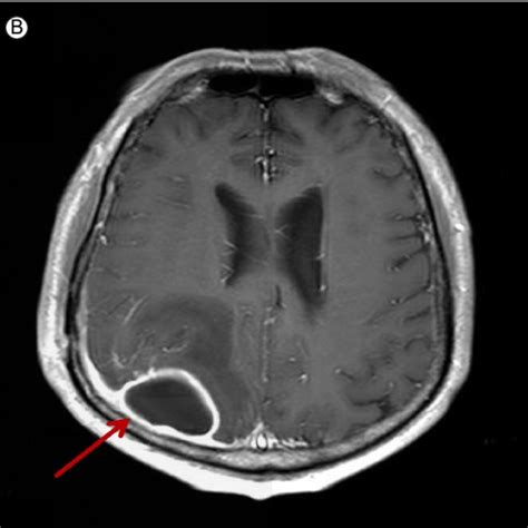 A Computer Tomography Of The Brain Subdural Effusion In The Right Download Scientific