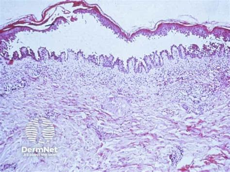 Pemphigus Vulgaris Images — Dermnet
