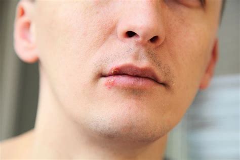 What Is Angular Cheilitis Health Detox Vitamins
