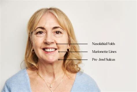 Marionette Lines Treatment Melbourne Enhance Your Beauty Cityskin