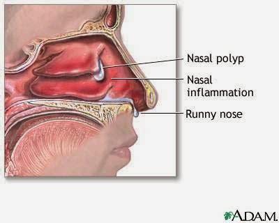 Nasal Polyps