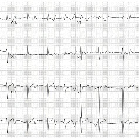 Electrocardiogram Shows Atrial Fibrillation Download Scientific Diagram