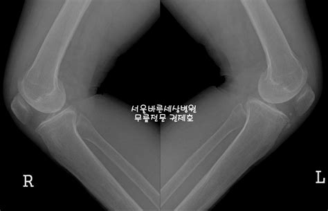 근위경골절골술 연골판파열 미세천공술 연골재생과 휜다리 교정하는 제이본정형외과 권제호 네이버 블로그
