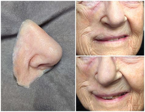 Life After Rhinectomy Custom Nose Prosthesis