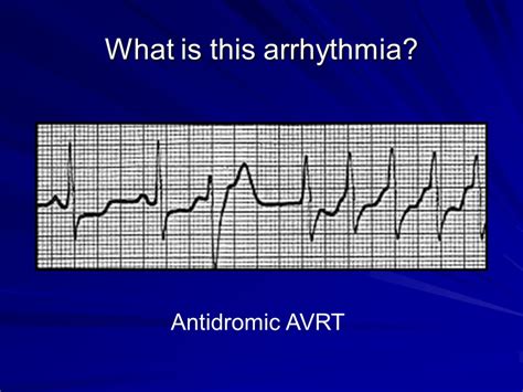 Arrhythmias And Ekgs Part 2 Outline Sinus Arrhythmia
