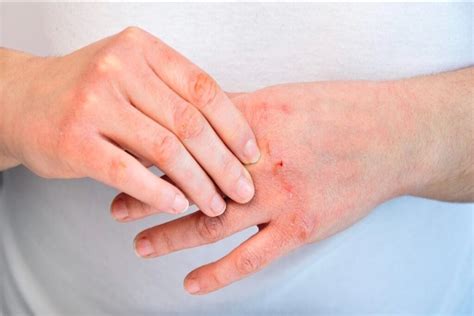 Atopic Dermatitis Causes Symptoms And Treatments